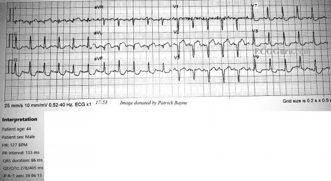 Instructors' Collection ECG: Onset of Pathological Q Waves | ECG Guru ... Instructors' Collection ECG: Onset of Pathological Q Waves | ECG Guru ...